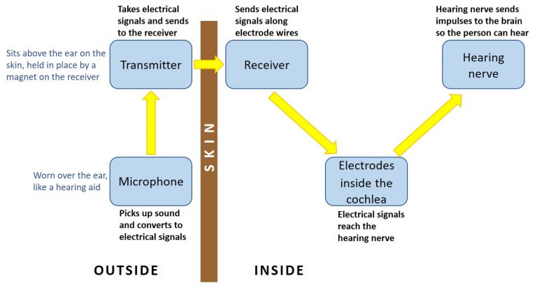 International Cochlear Implant Day - Hearing Matters