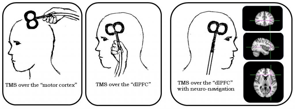 Accelerated TMS for Pain Inhibition: The BoostCPM Study - NIHR ...